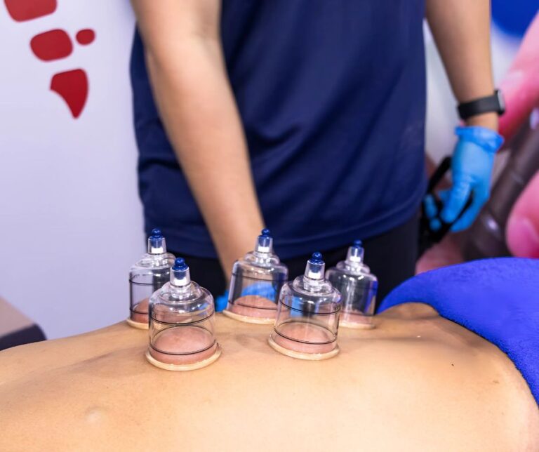 Cupping Therapy